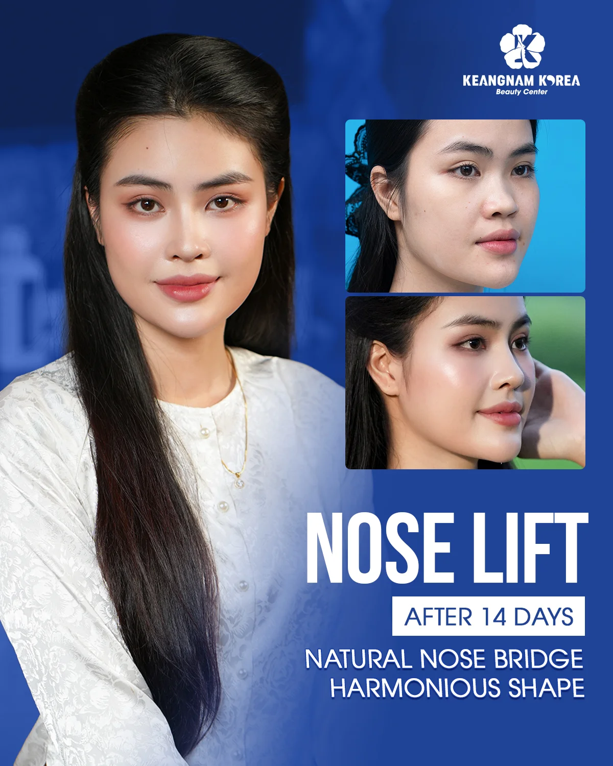 Nose lift - Keangnam Korea